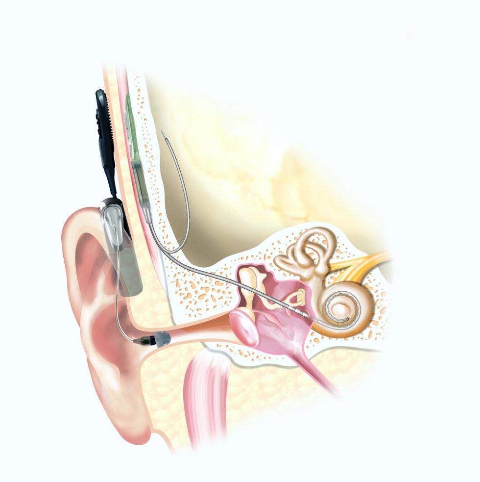 Cochlear Implant | AudioHearing Melbourne